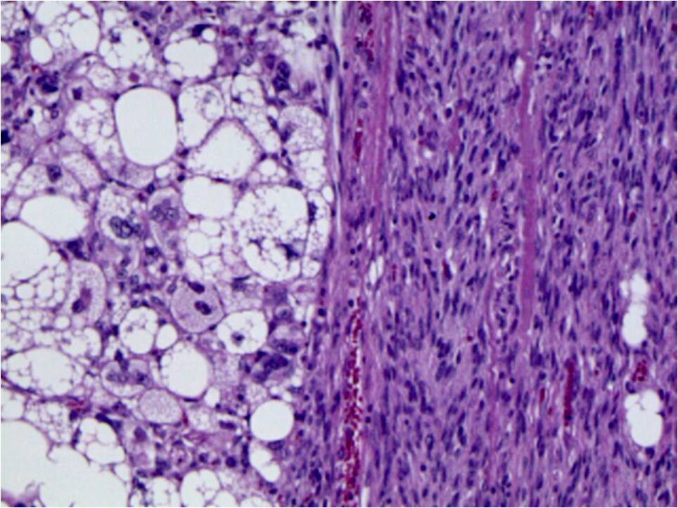 Dedifferentiated Liposarcoma Pathology Outlines - Dedifferentiated liposarcoma